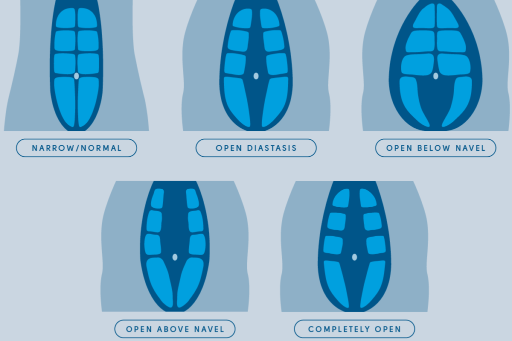 Diastasis Rectus Abdominis (DRA) - Rehab Concepts
