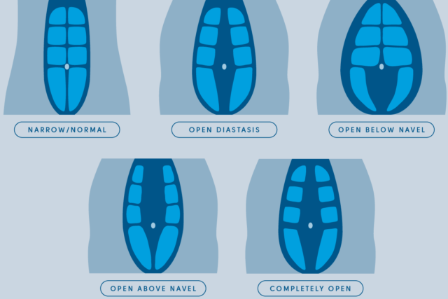 Diastasis Rectus Abdominis Dra Rehab Concepts